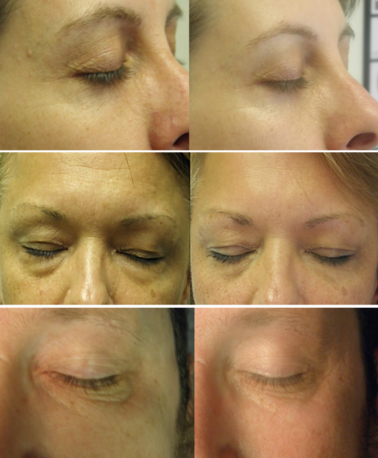 Poly Red Light Therapy - Skin Rejuvenation is here!